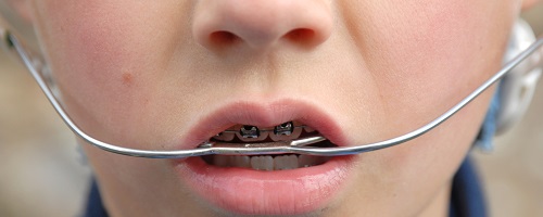 Zahnspangen: Welche Arten gibt es?